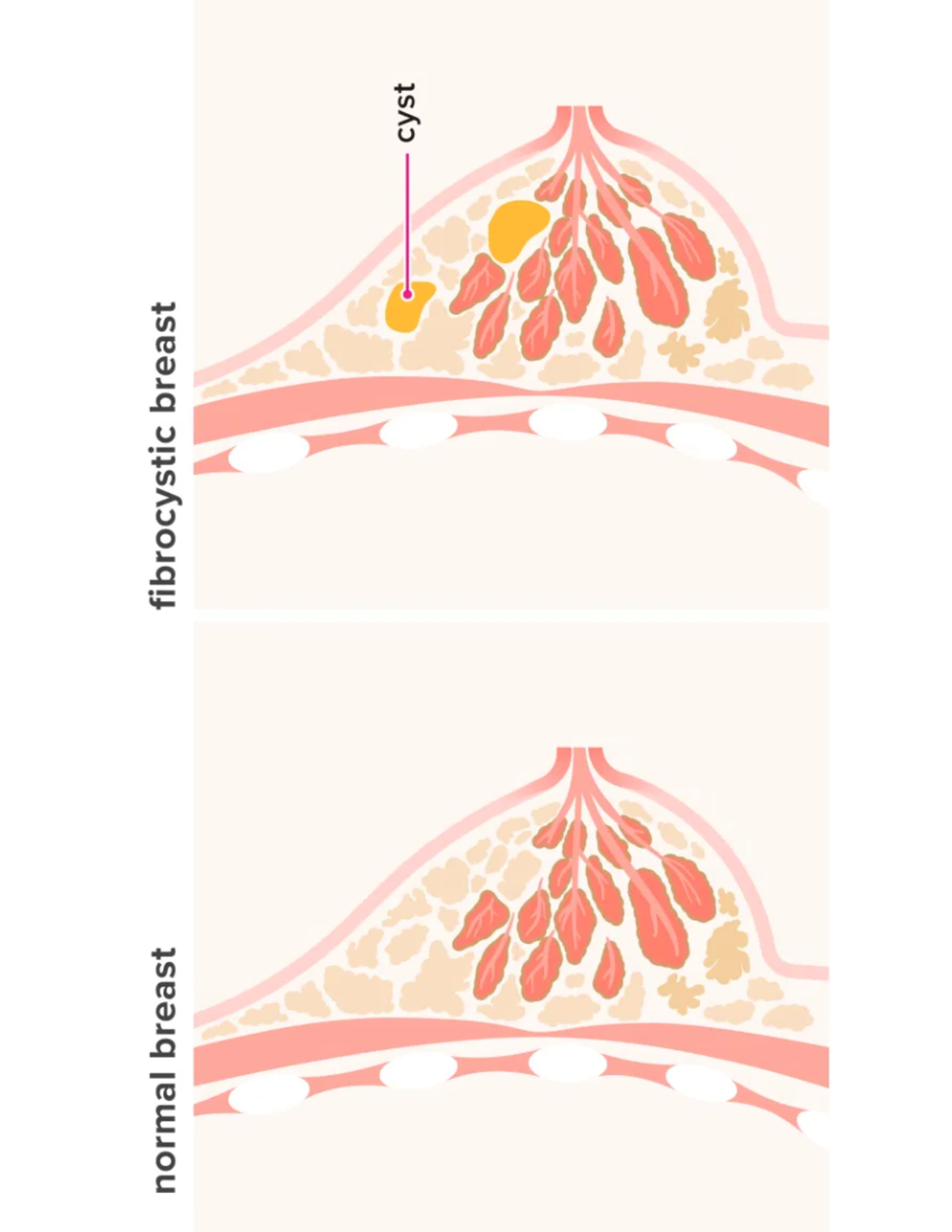 breast notes for help - Nursing 50 - Studocu