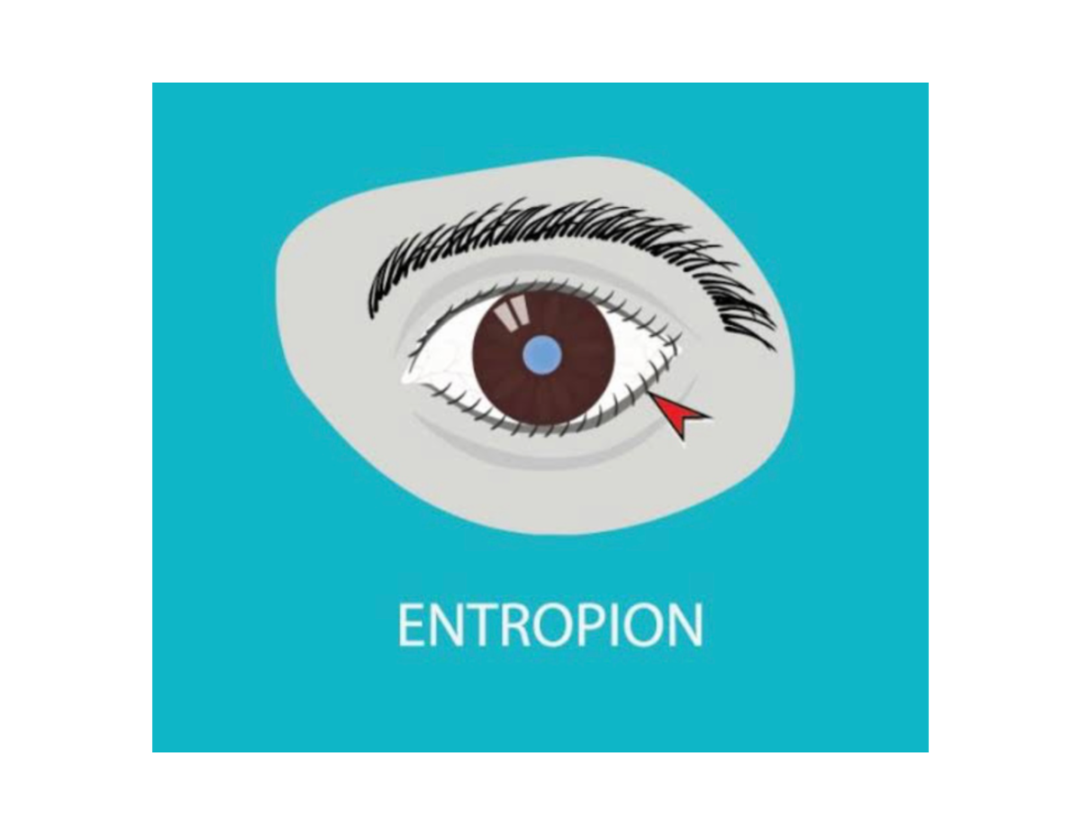 Entropion eye disease - Bsc.optometry - Studocu