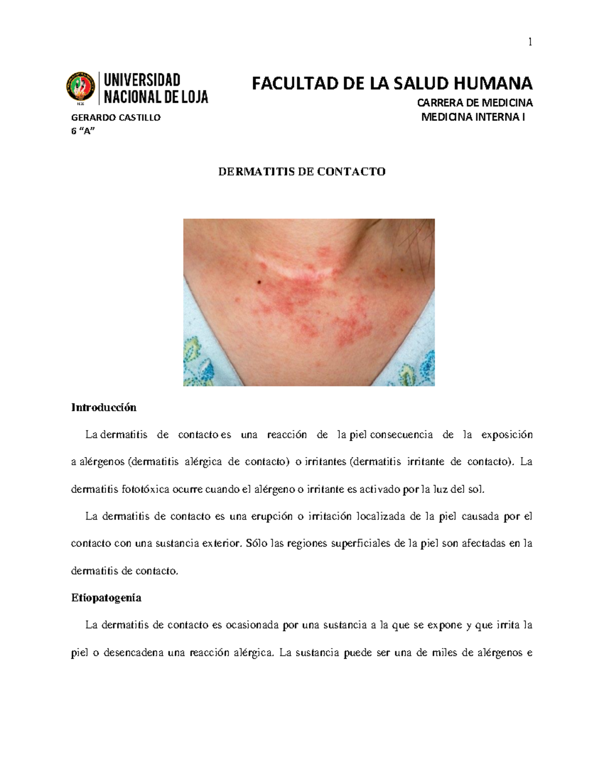 Dermatitis de Contacto - La dermatitis fototóxica ocurre cuando el ...