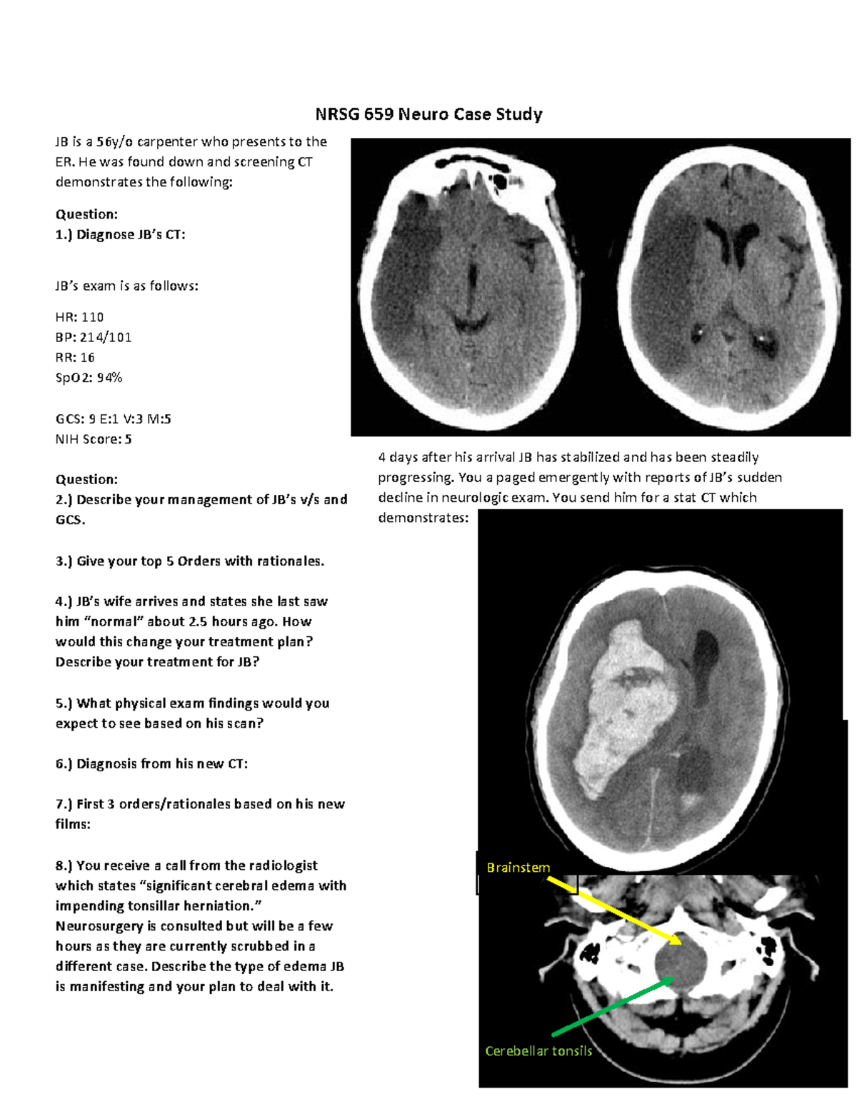 Neuro Case Study #1 - NRSG 659 Neuro Case Study Area of infarct JB is a ...