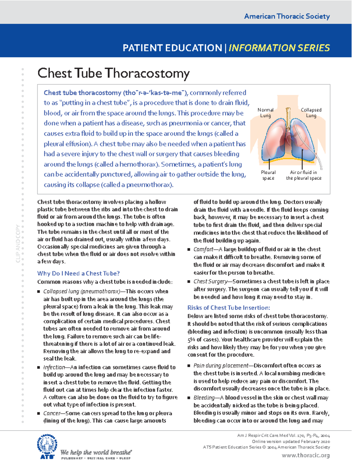Chest-tube-thoracostomy - American Thoracic Society PATIENT EDUCATION ...
