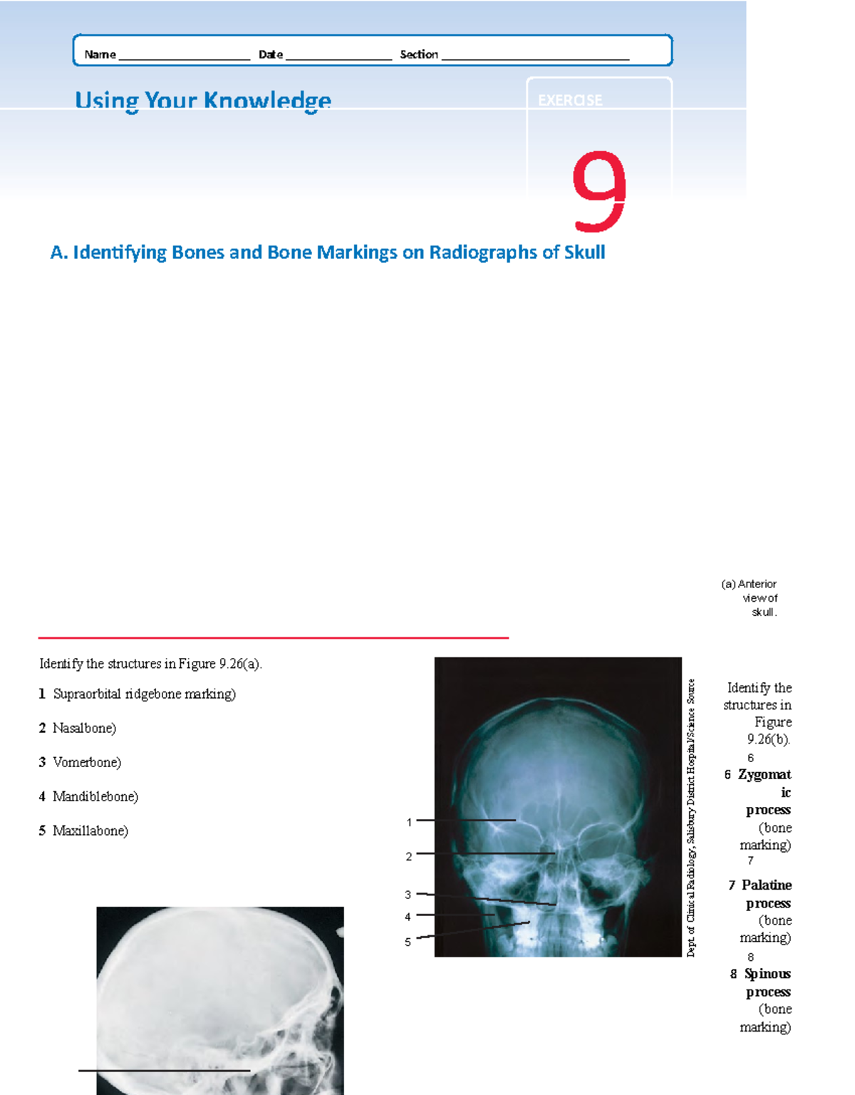 Identifying Bones And Bone Markings On Radiographs Of Skull - Name Date ...