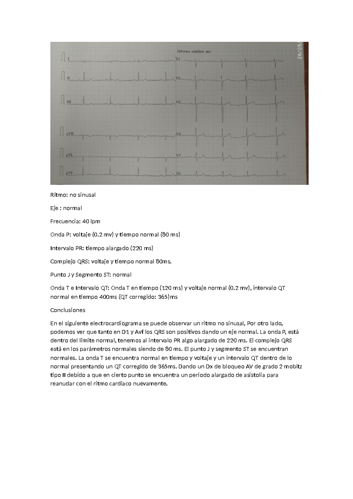 Electro 5 - Ritmo: no sinusal Eje : normal Frecuencia: 40 lpm Onda P ...