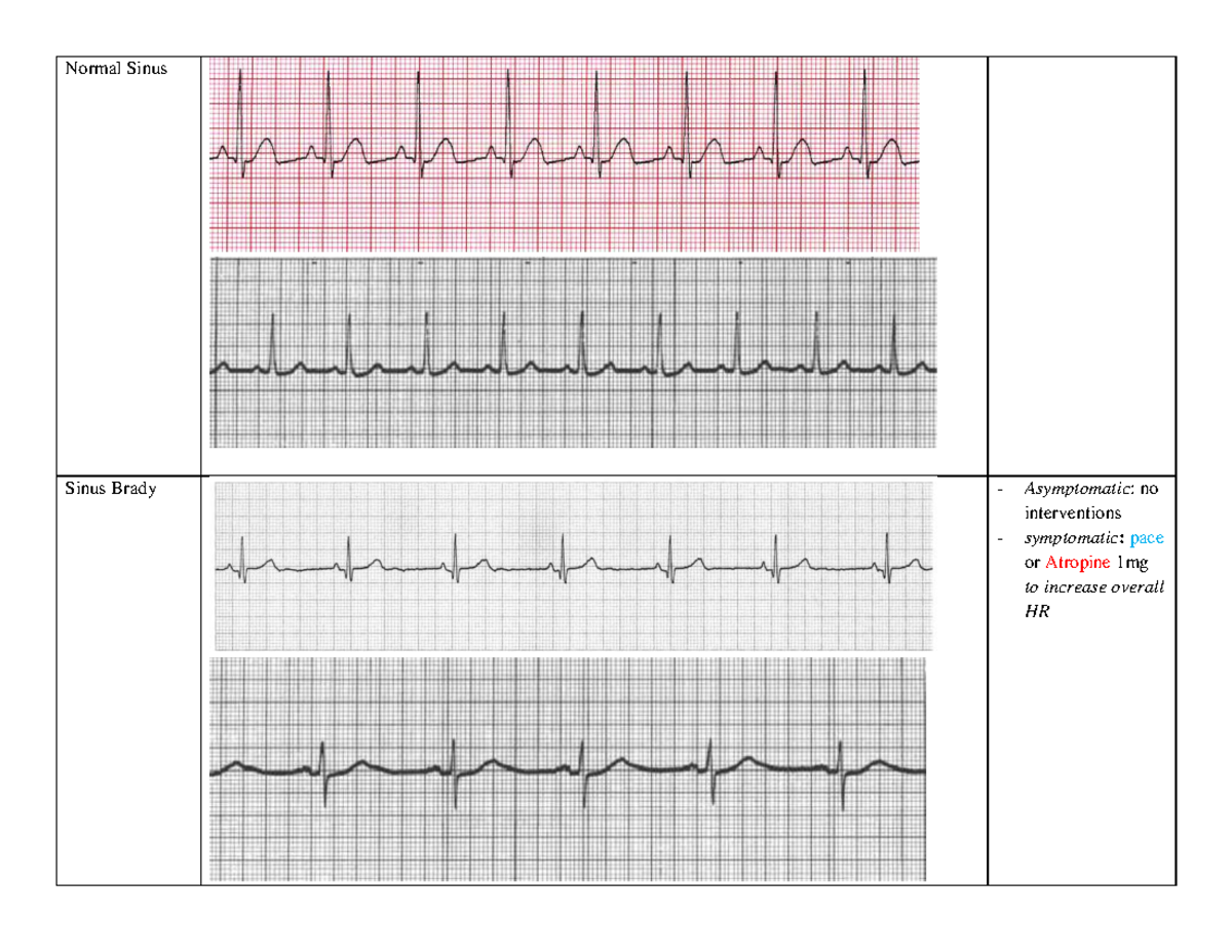EKG Notes - reading strips - Normal Sinus Sinus Brady - Asymptomatic ...