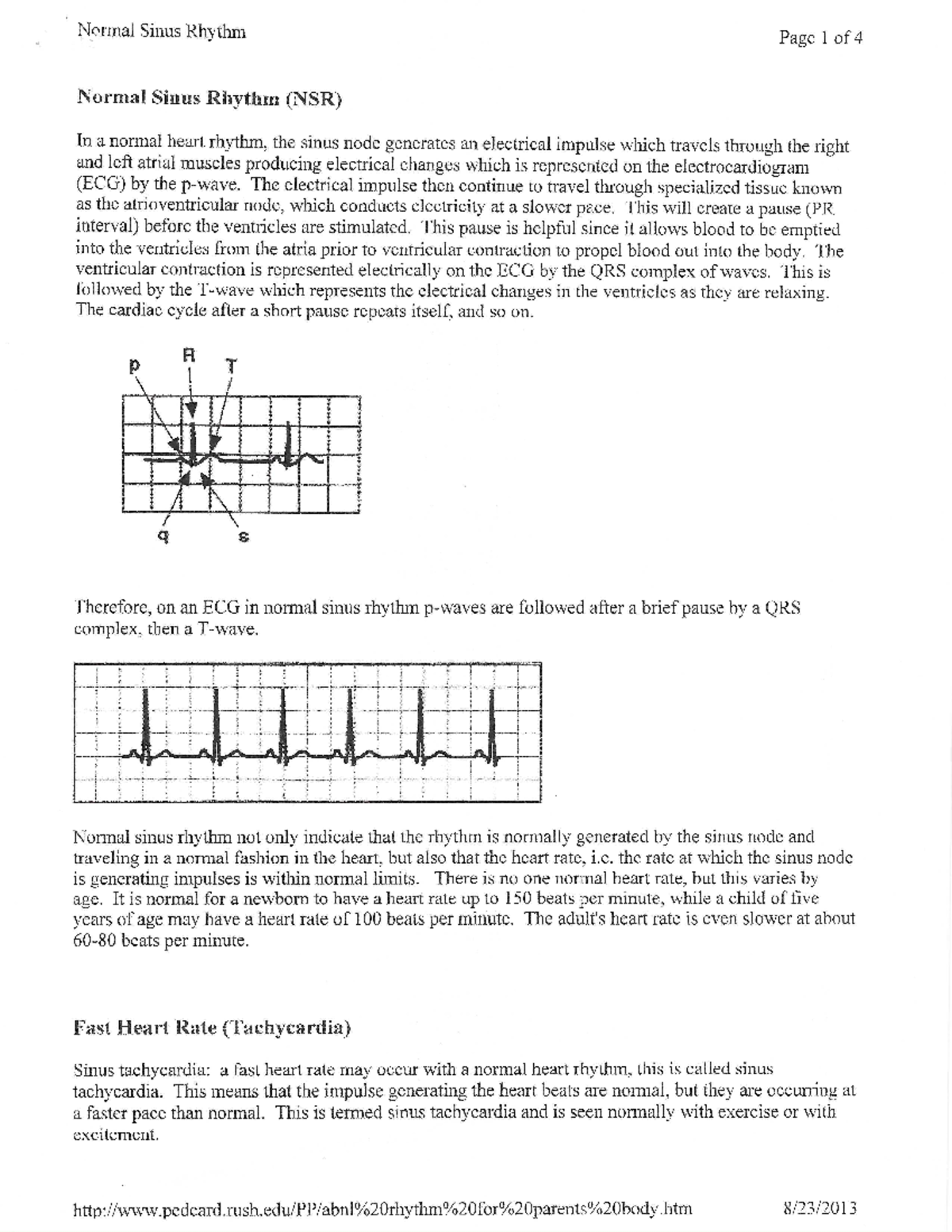 EKG Interpretation SR, ST, SVT, AFIB, Aflutter, Complete Heart Block ...