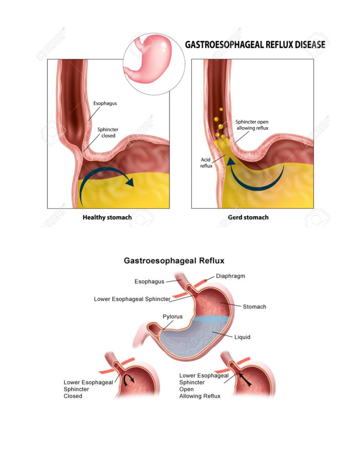 Gastro-Esophageal Reflux Disease (GERD) - 2- The sphincteric function ...