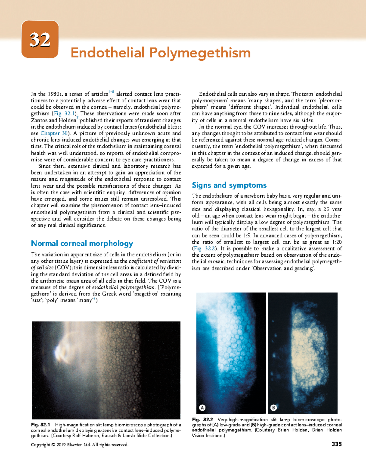 Endothelial Polymegethism Contact Lens Complications - 3232 Endothelial ...