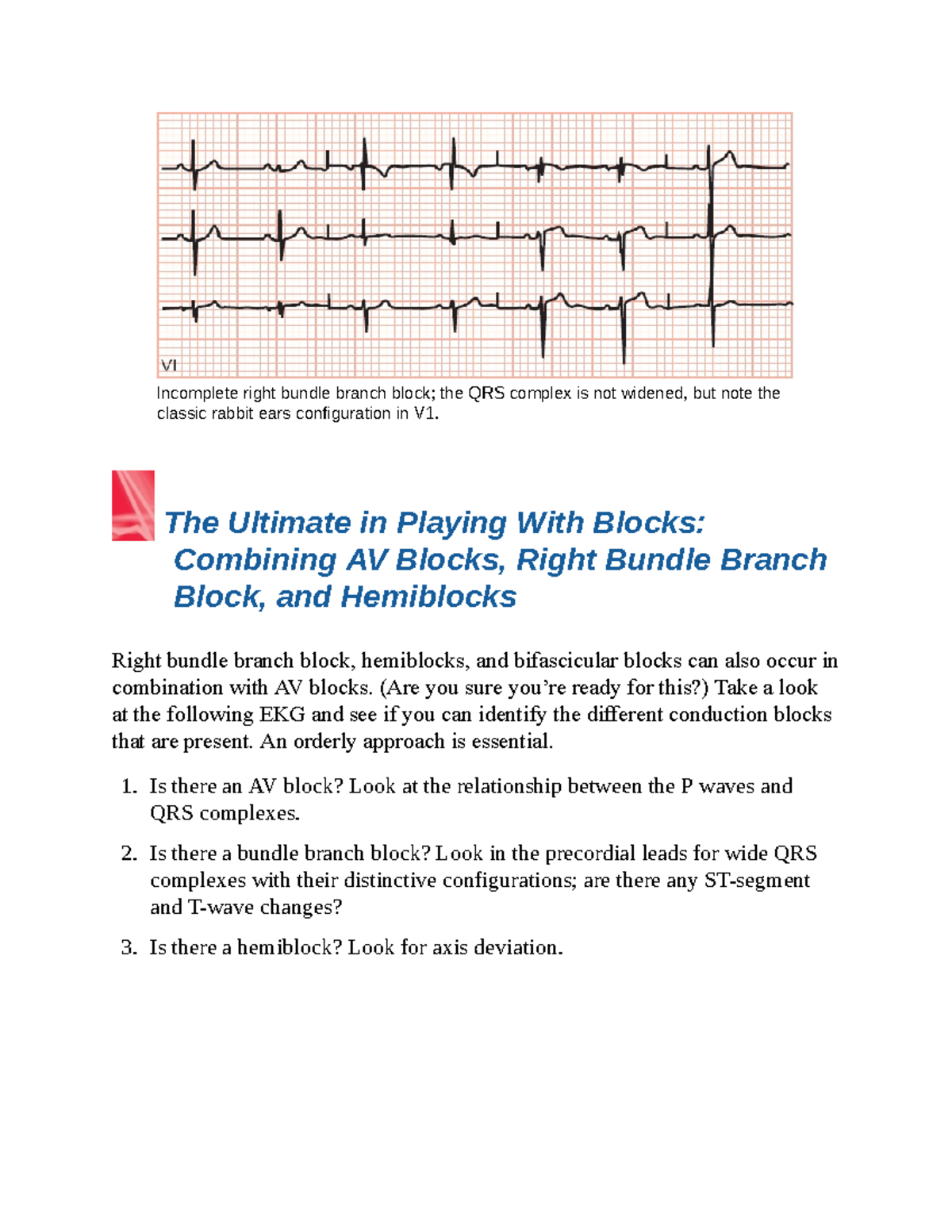 The only EKG-72 - The only EKG - Incomplete right bundle branch block ...