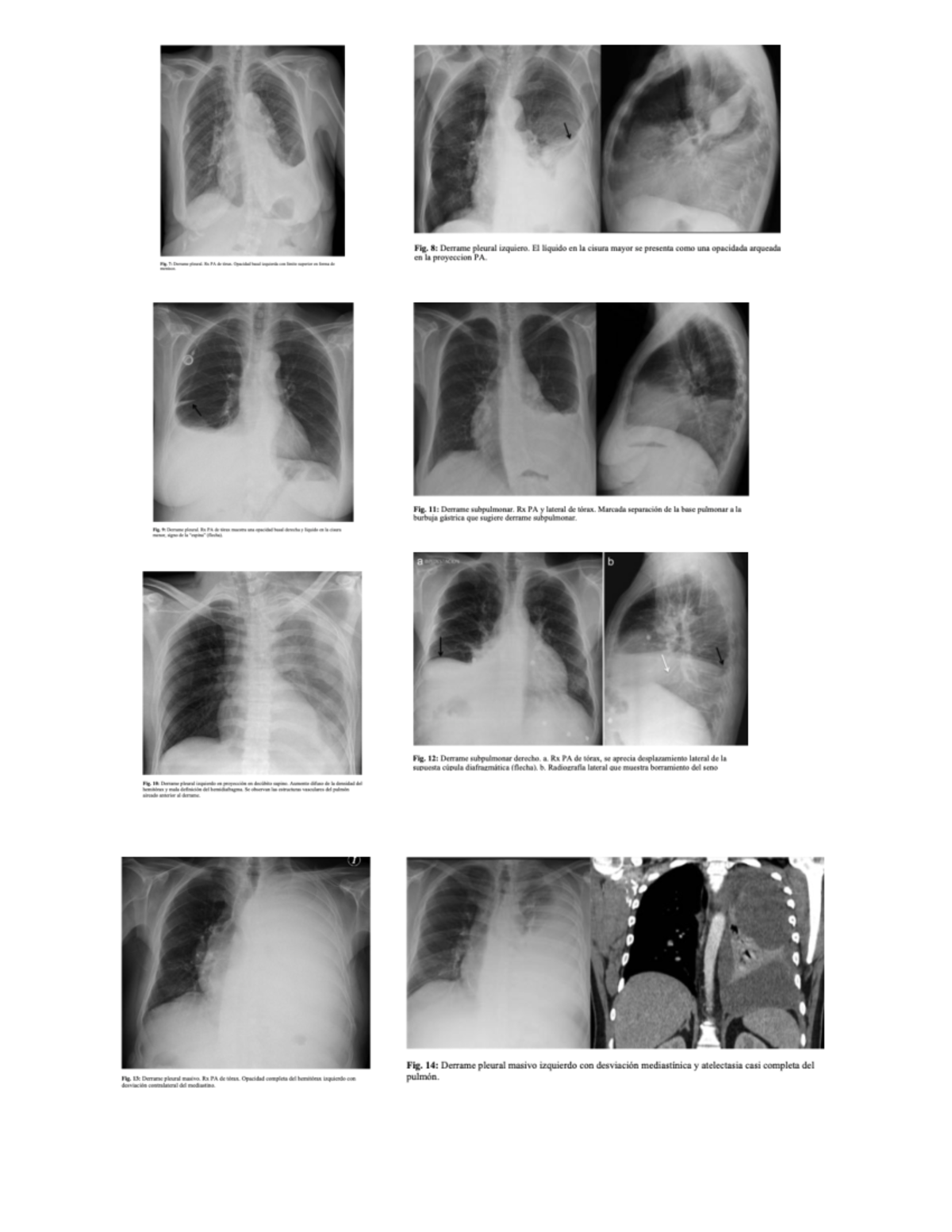 Signos Radiológicos Torax - Radiología - Studocu