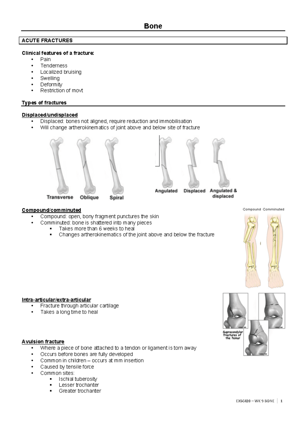UOW EXSC420 - Bone Notes - Bone ACUTE FRACTURES Clinical features of a ...