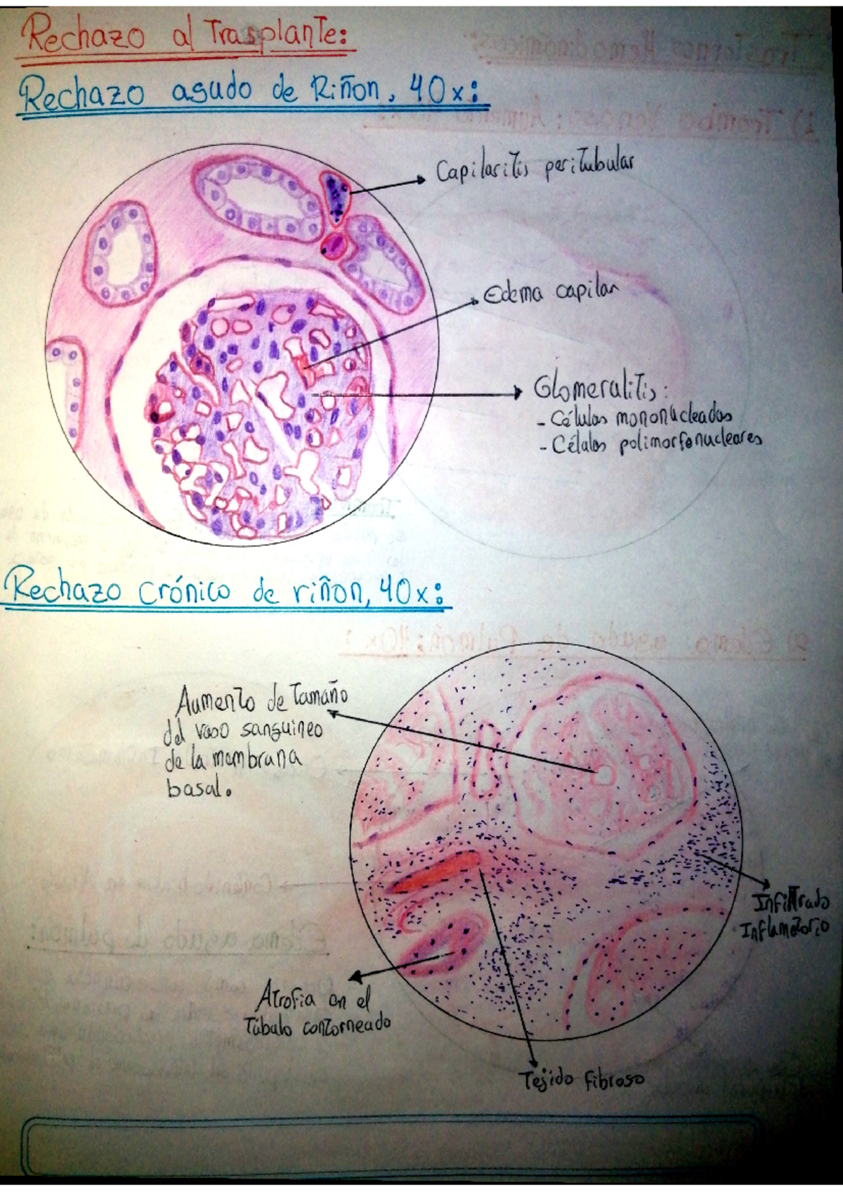 Dibujos patologia-Semana 4 - Rechazo al Trasplante: Rechazo asudo de ...