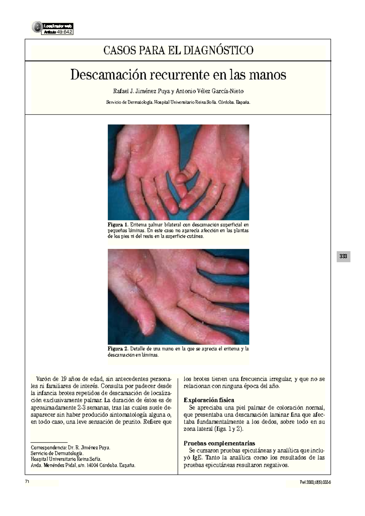 S0213925103727269 - Dermatitis exfoliativa de manos y su tratamiento ...
