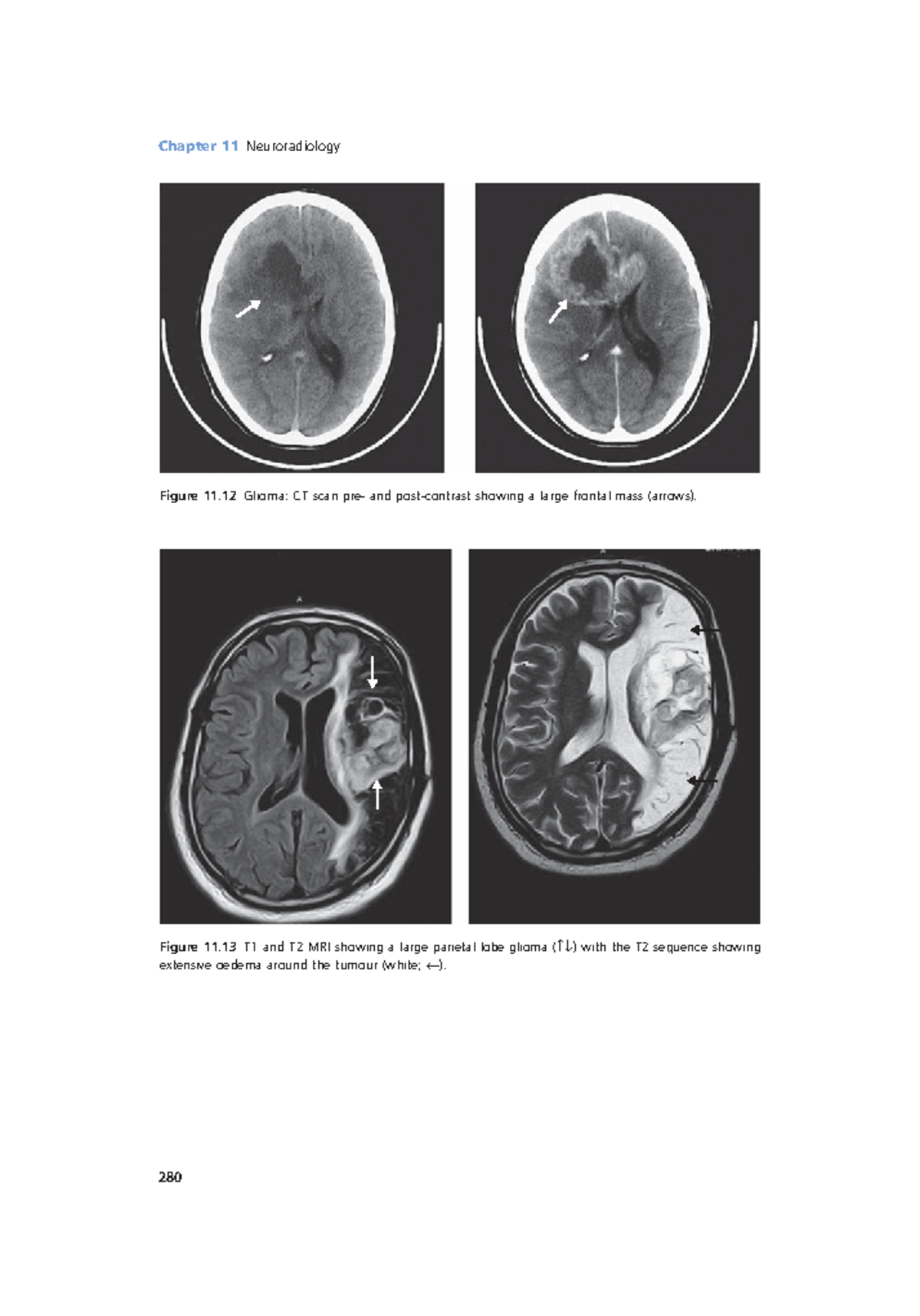 Radiology Lecture Notes pdf (94) - Chapter 11 Neuroradiology 280 Figure ...