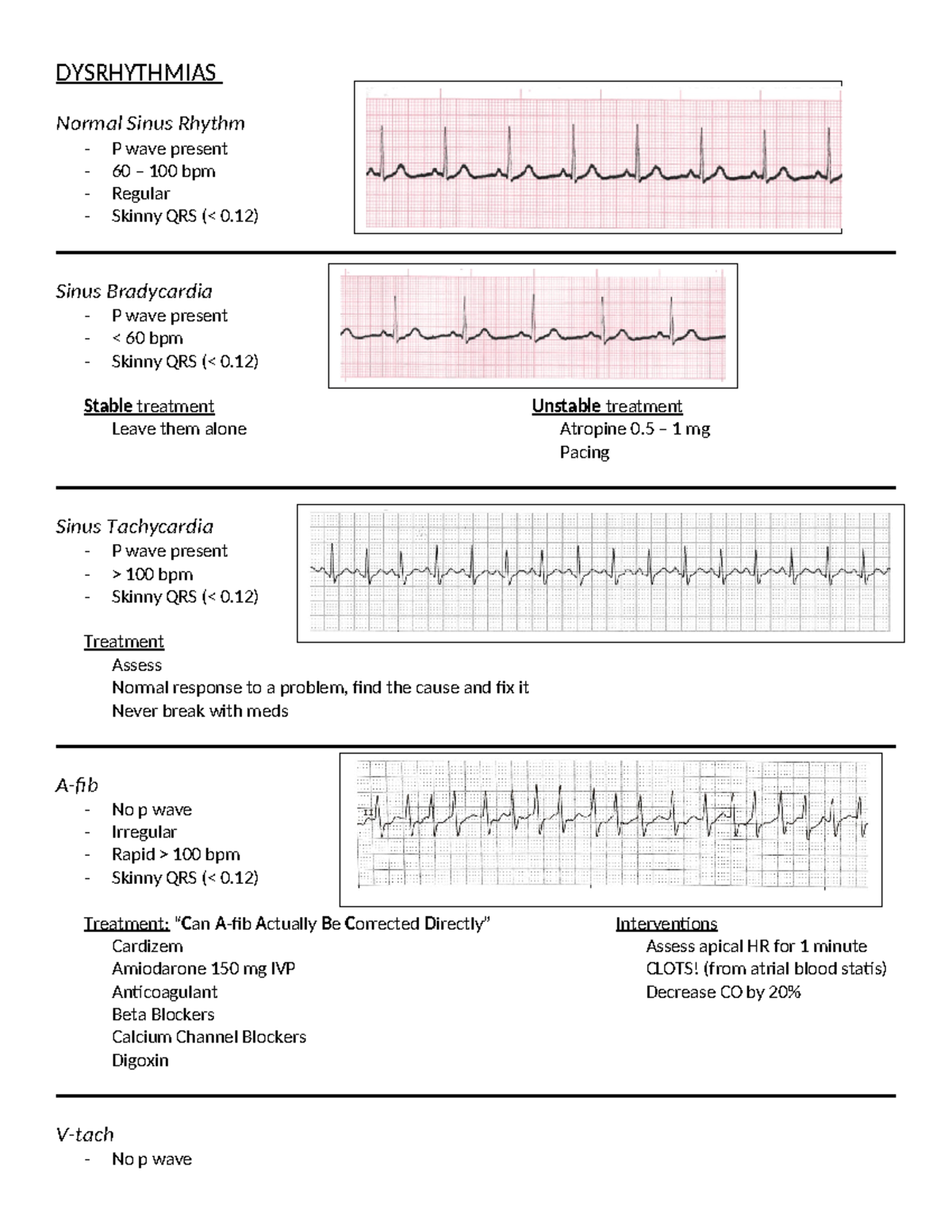 Dysrhythmias study guide - DYSRHYTHMIAS Normal Sinus Rhythm - P wave ...