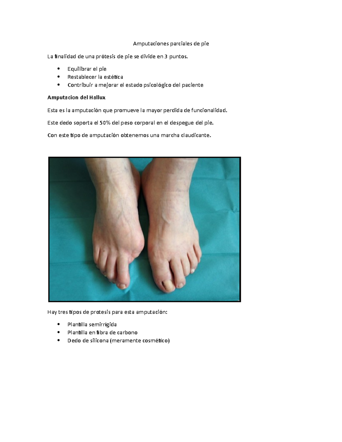 Amputaciones parciales de pie - Equilibrar el pie Restablecer la ...