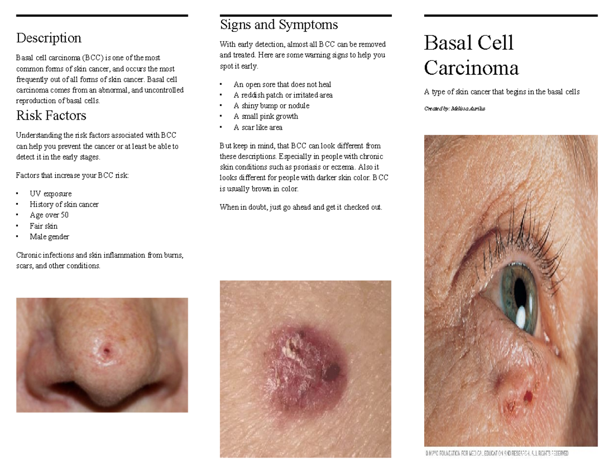 BCC Brochure - Homework assignment - Description Basal cell carcinoma (BCC) is one of the most ...