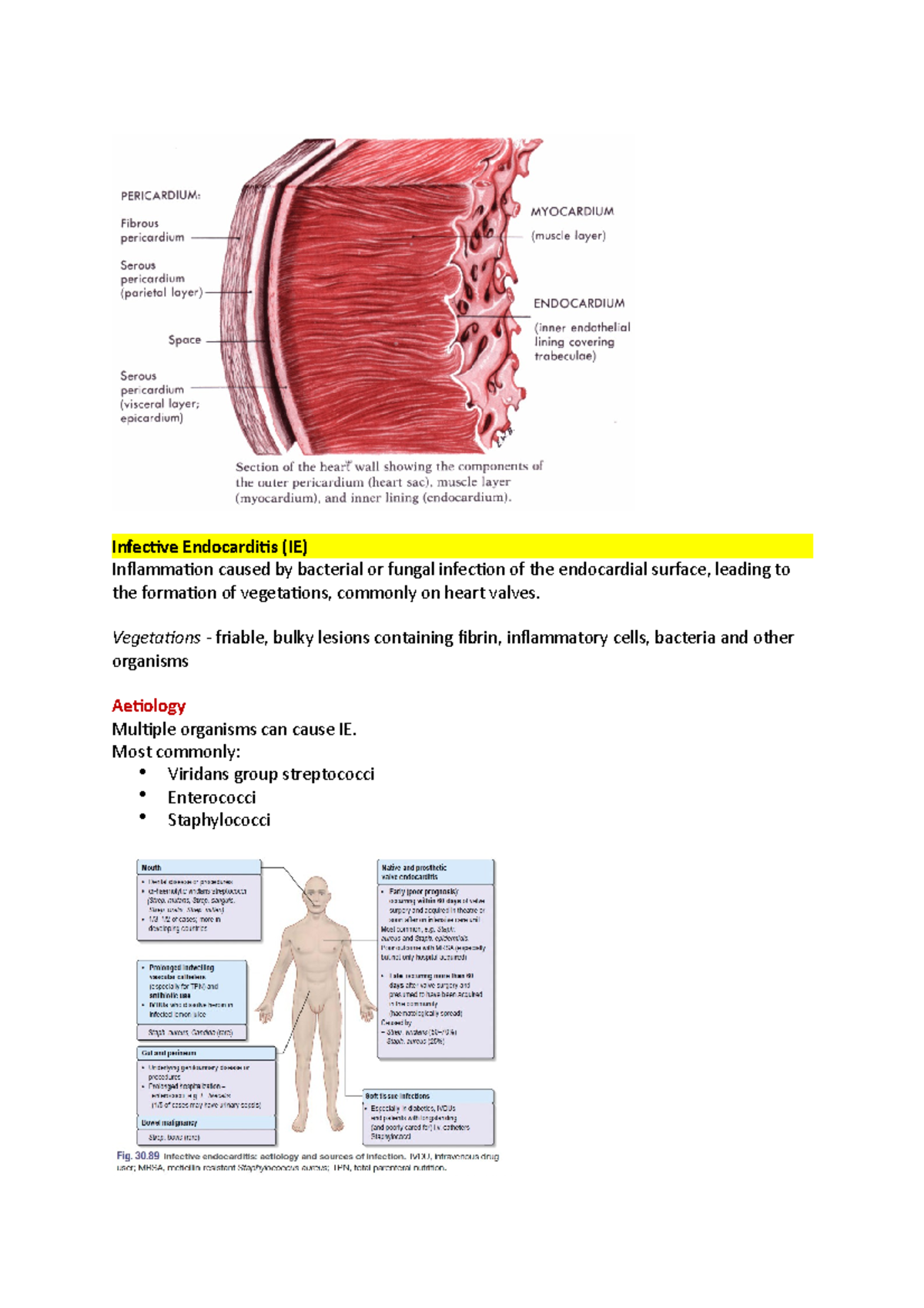 Infective Endocarditis - Vegetations - friable, bulky lesions ...