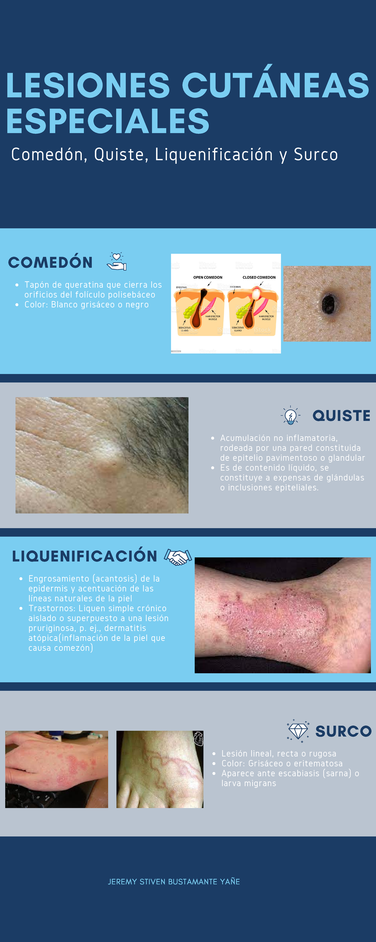 Lesiones Cutáneas especiales - Engrosamiento (acantosis) de la ...
