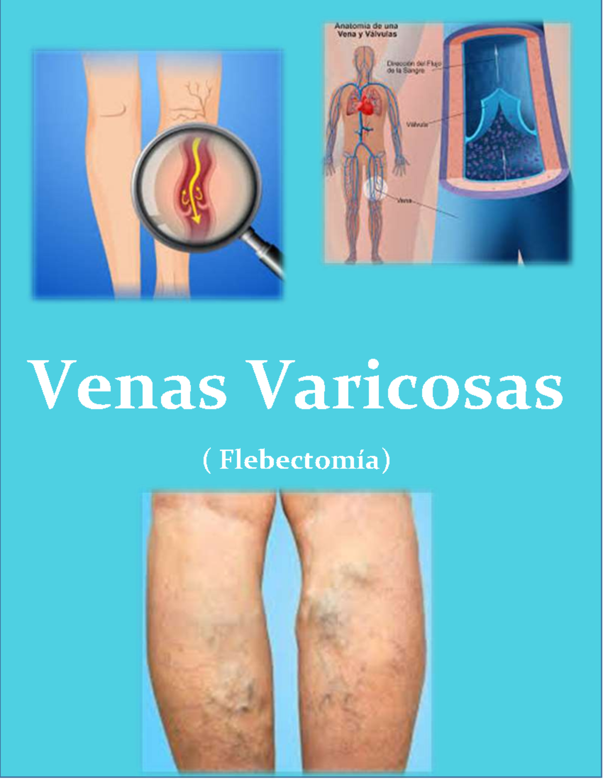 Trabajo final de fisiopatologia I-Venas varicosas-Flebectomia - Venas ...