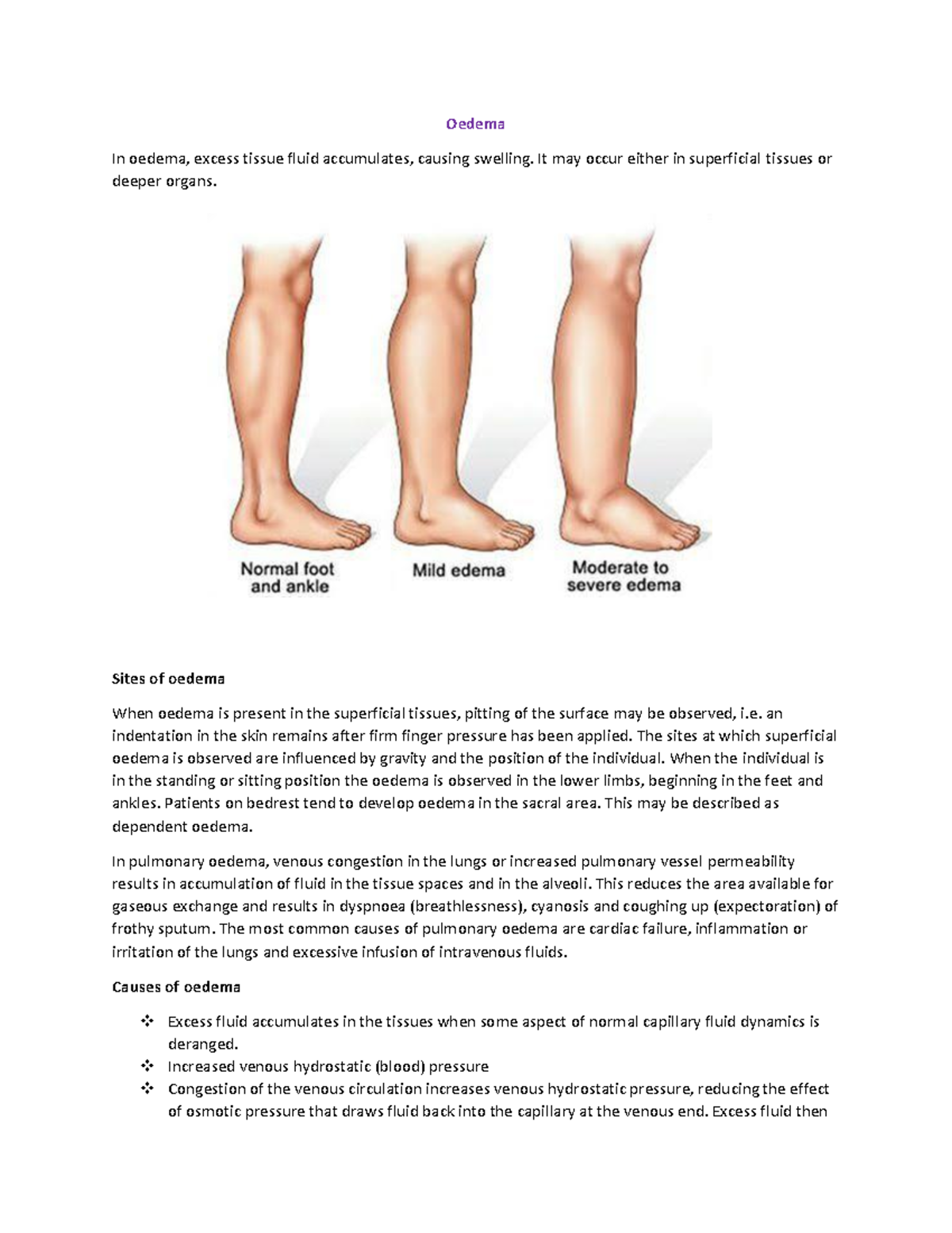 Oedema - Oedema In oedema, excess tissue fluid accumulates, causing ...