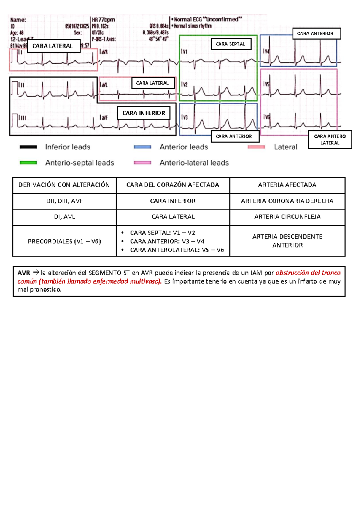 ECG Localización de lesiones - CARA INFERIOR CARA LATERAL CARA LATERAL ...