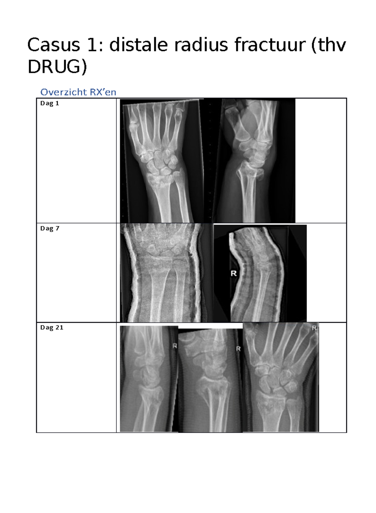 Casussen pols - Casus 1: distale radius fractuur (thv DRUG) Overzicht ...