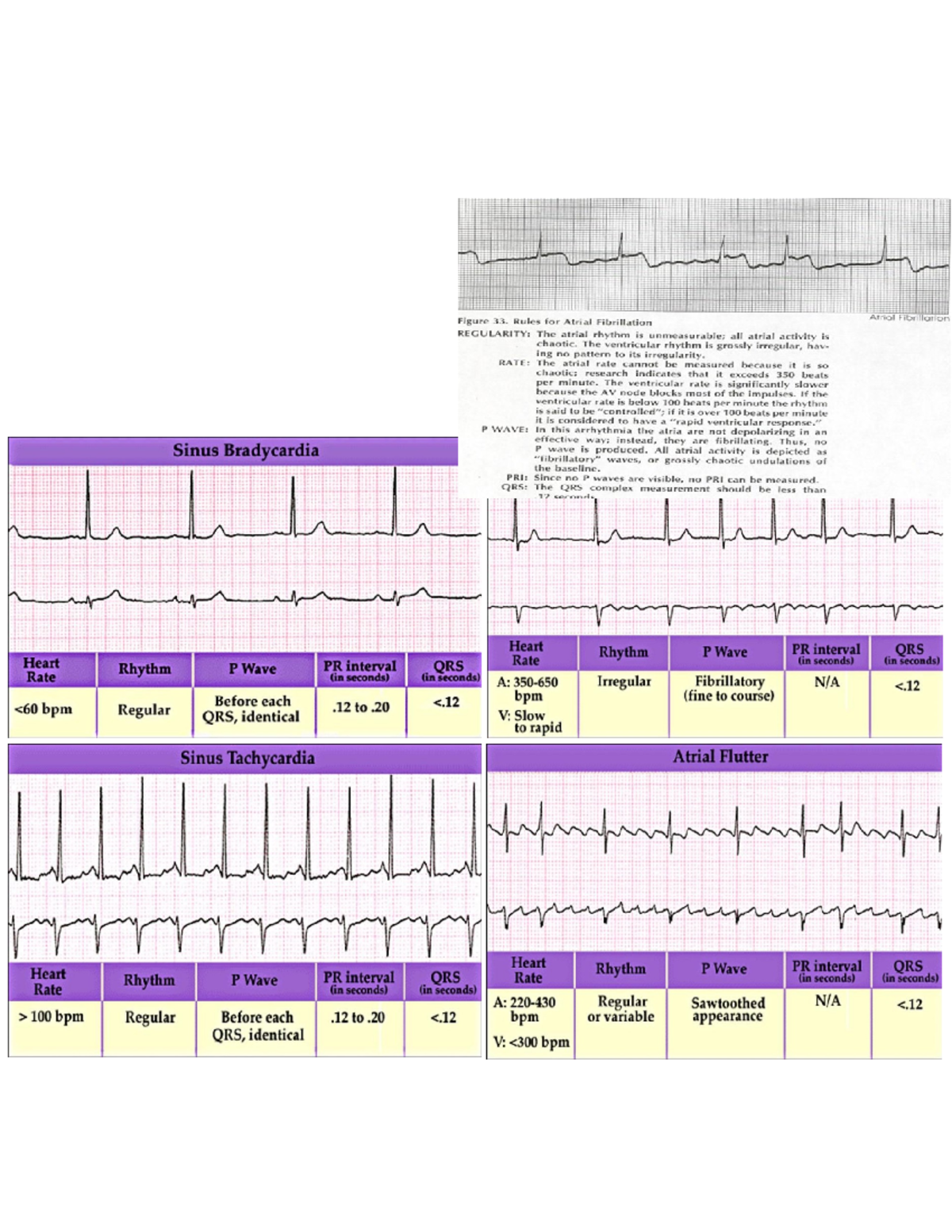 Additional ECG Practice Interpretations - NUR 439 - e - Studocu