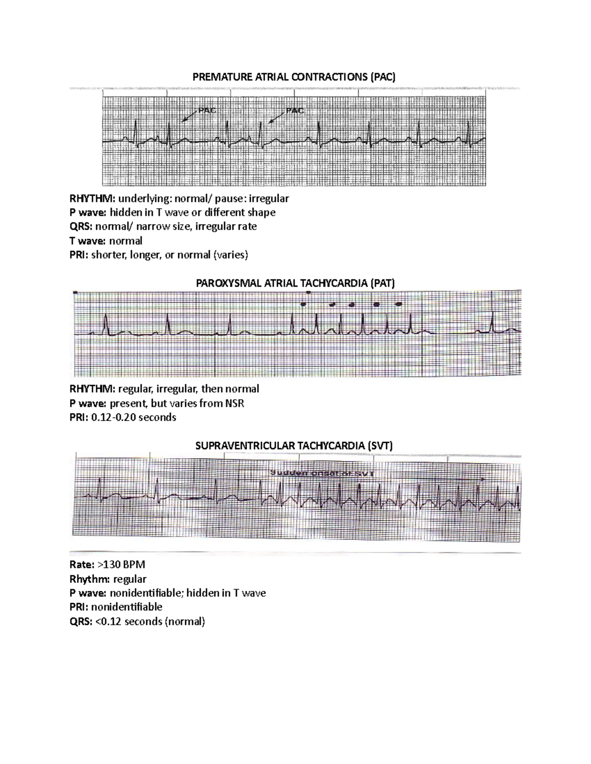Atrial Dysrhythmias-Study Sheet - PREMATURE ATRIAL CONTRACTIONS (PAC ...