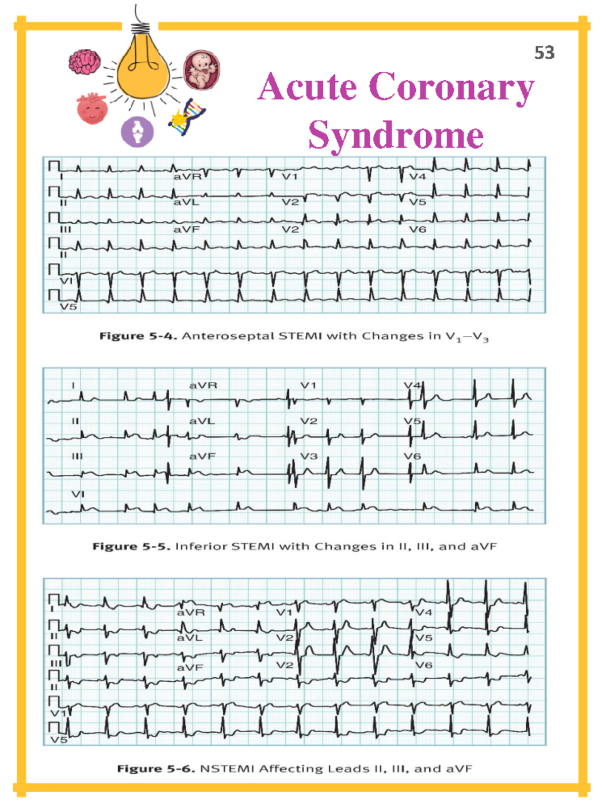 Cardiology-14 - Cardiology - Acute Coronary Syndrome Anteroseptal STEMI ...