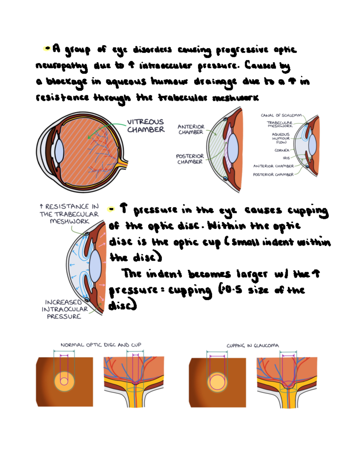 Gradual loss of vision (open angle glaucoma) - A ####### group of ...