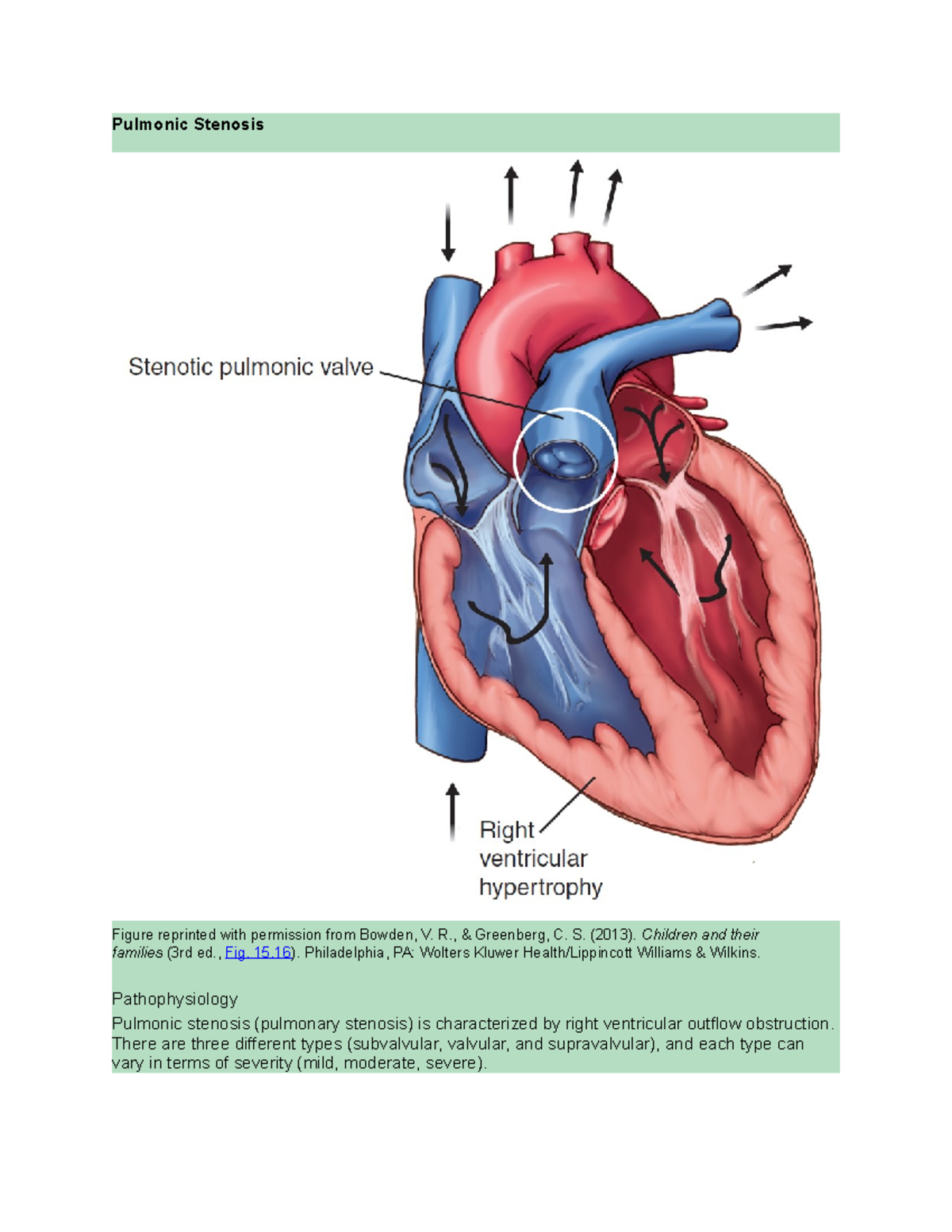 Pulmonic Stenosis & DRAWING - Pulmonic Stenosis Figure reprinted with ...