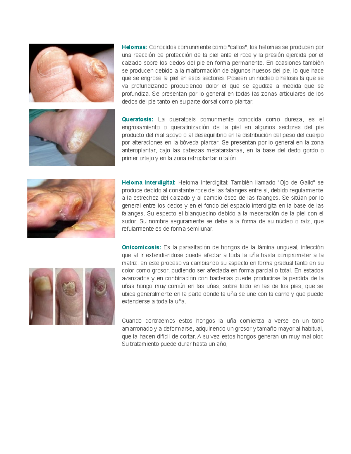 Helomas - hjyygfggh - Helomas: Conocidos comunmente como "callos", los ...