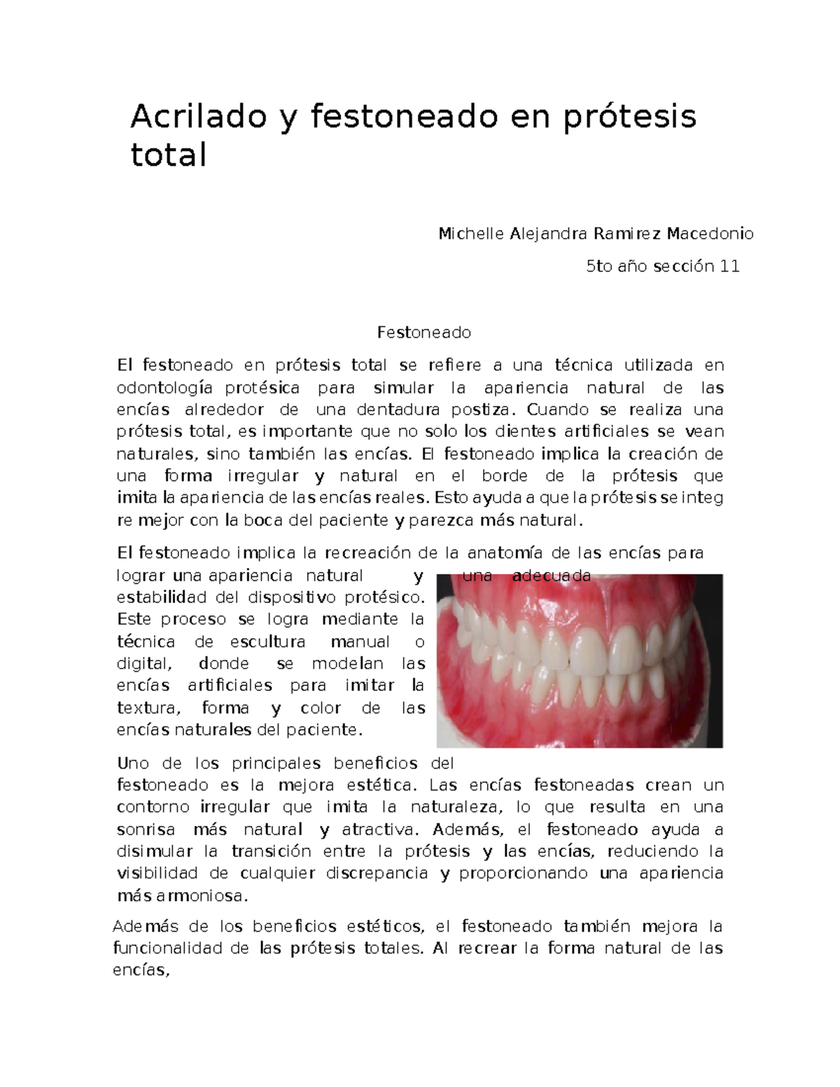 Acrilado y festoneado en prótesis total final - Ac ril ado y fes ...