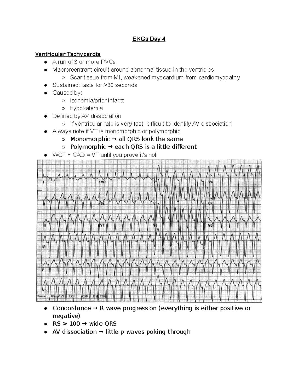 EKGs Day 4 - Lecture notes on EKGs - EKGs Day 4 Ventricular Tachycardia ...