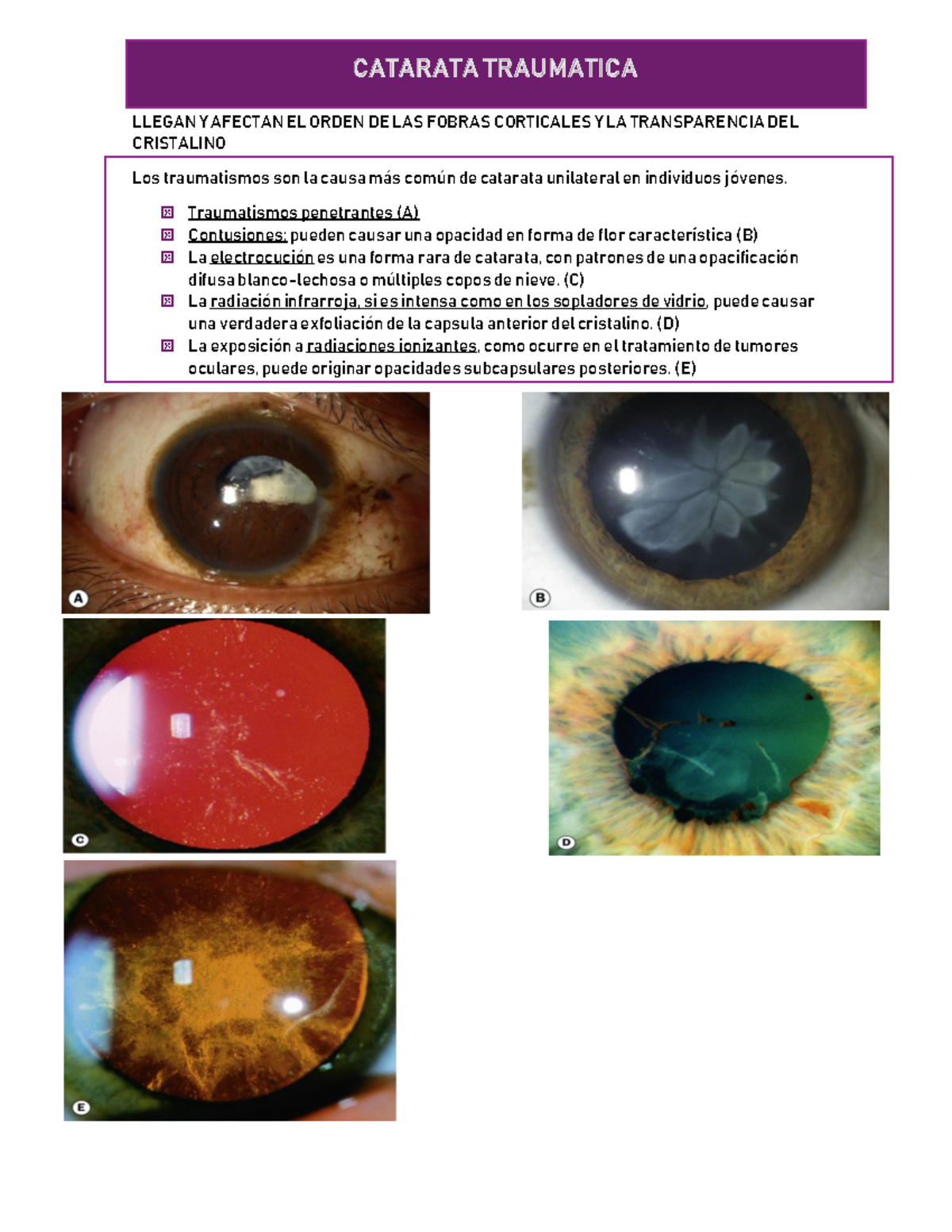 Catarata traumatica - CATARATA TRAUMATICA LLEGAN Y AFECTAN EL ORDEN DE ...