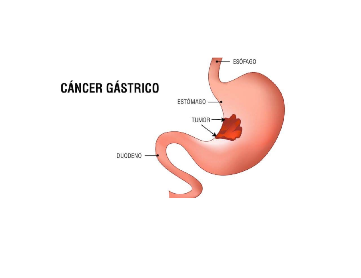 Cáncer gástrico - exposicion - Cáncer gástrico - Studocu