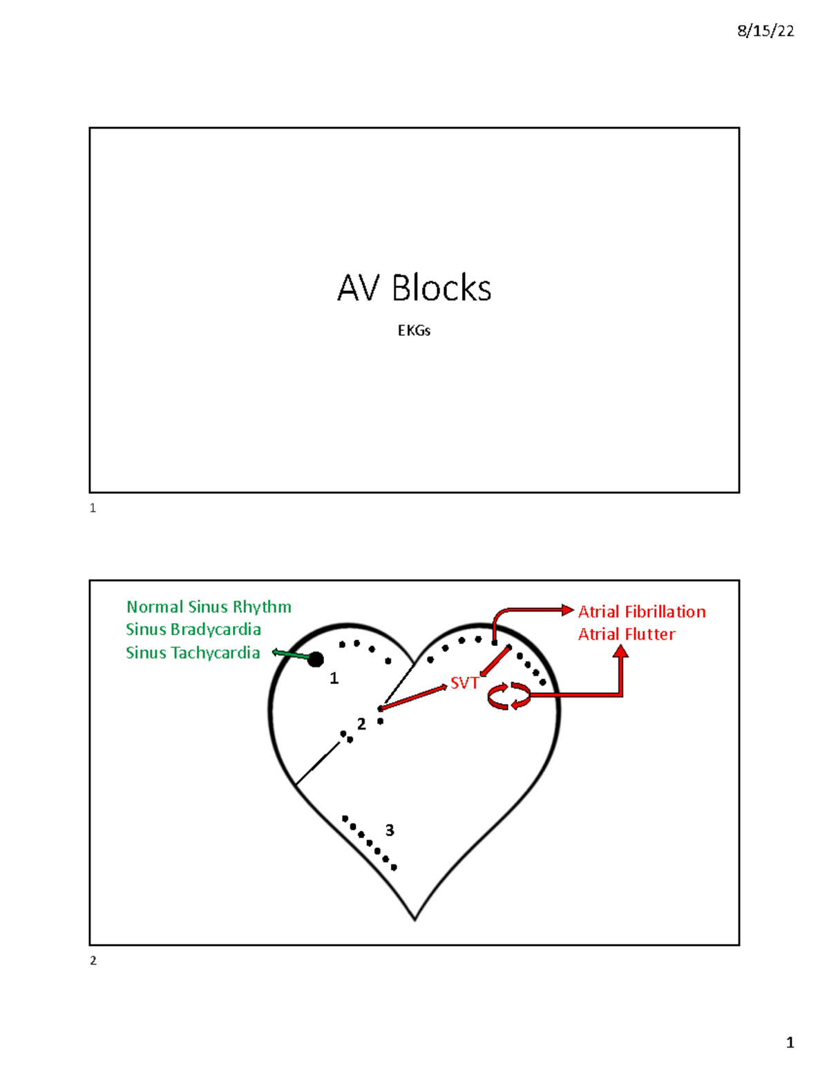 AV Blocks - Read-Only - AV Blocks EKGs 1 ####### Normal Sinus Rhythm ...