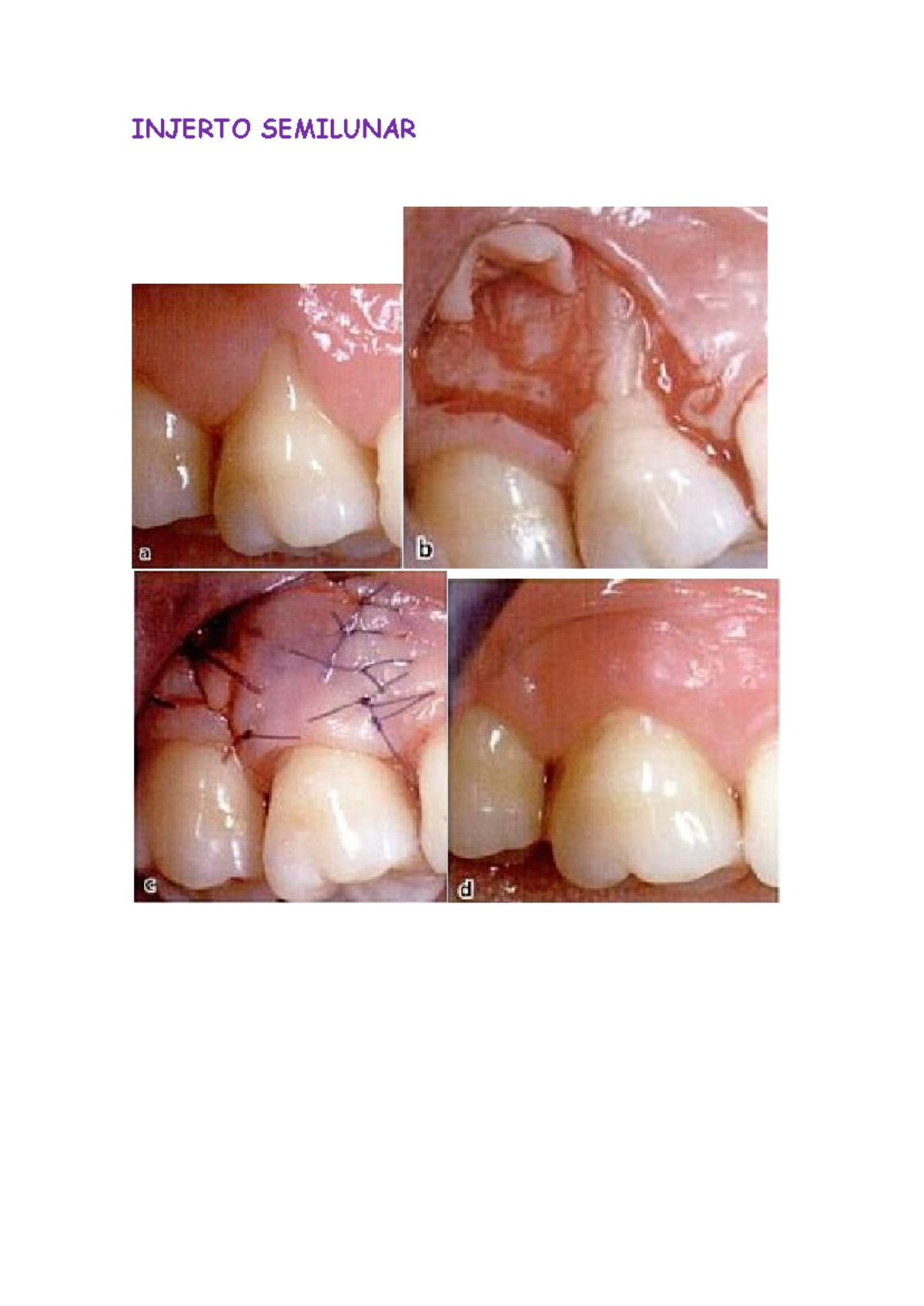 Tecnicas quirurgicas perio - INJERTO SEMILUNAR TÈCNICA: Se coloca ...
