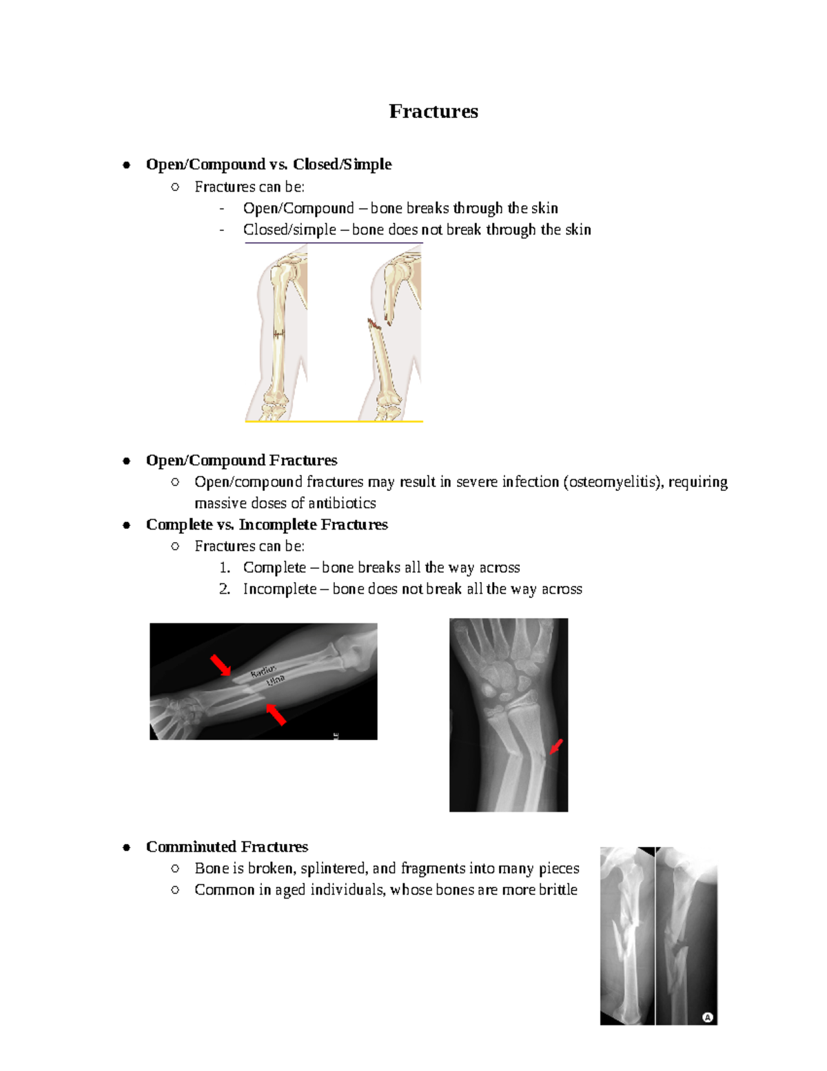 Complete Compound Fracture