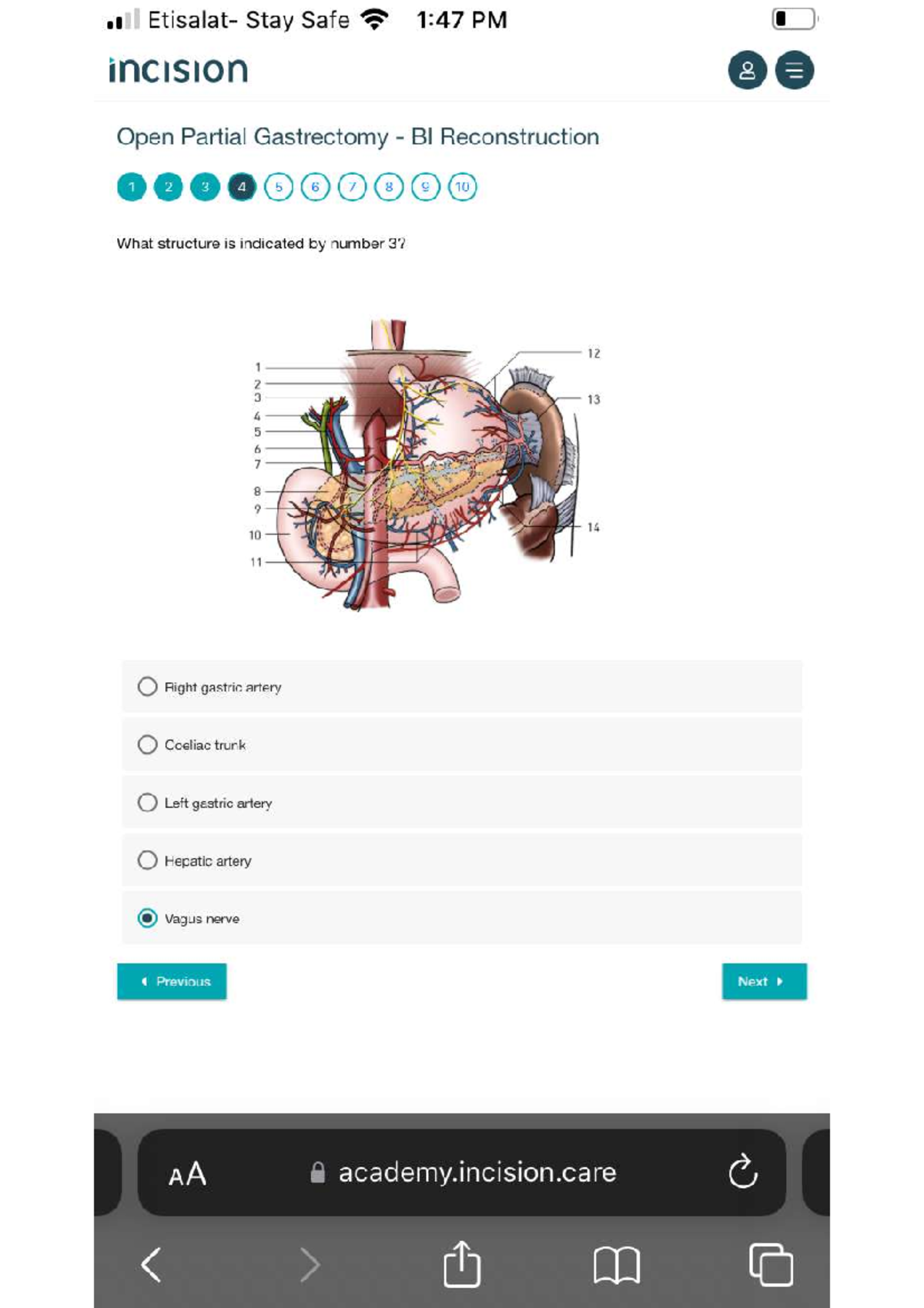 Open Partial Gastrectomy 3 - Internal Medicine - Studocu