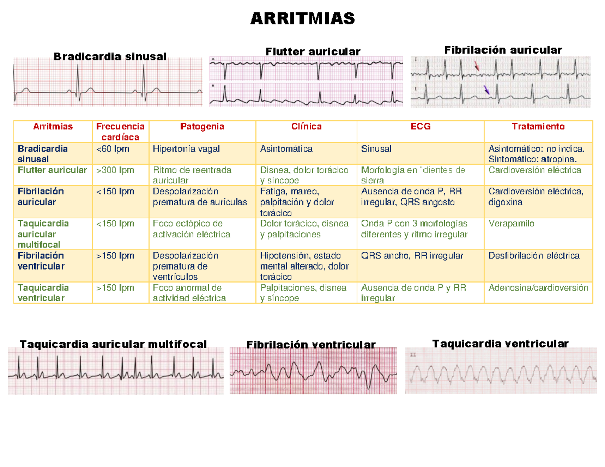 Infografía de Arritmias - Cruz Martínez Luis Eduardo - ARRITMIAS ...