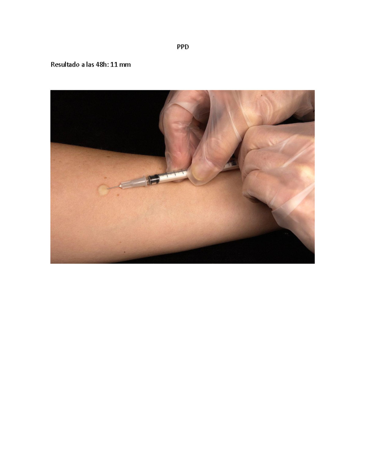 PPD - PPD - Neumología - PPD Resultado a las 48h: 11 mm PPD Resultado a ...