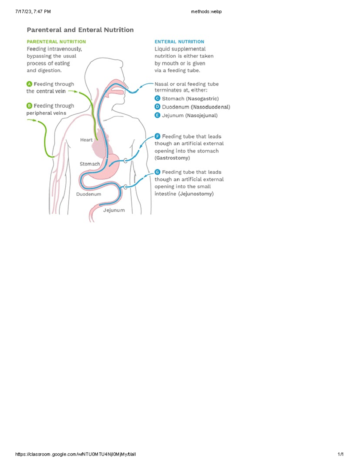 Parenteral and Enteral Nutrition - via a feeding tube. A Feeding ...