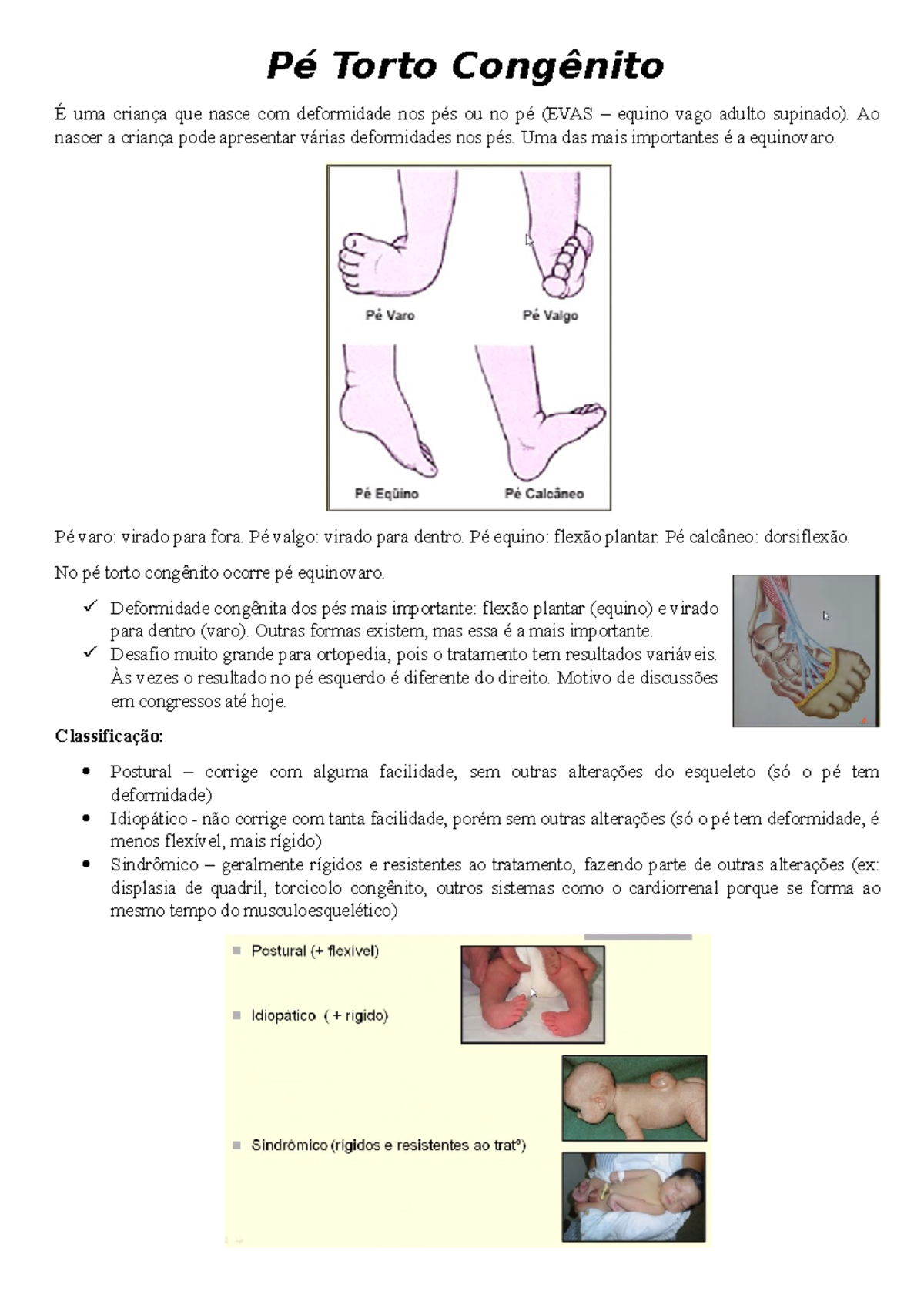 Pé Torto Congênito - Pé Torto Congênito É uma criança que nasce com ...