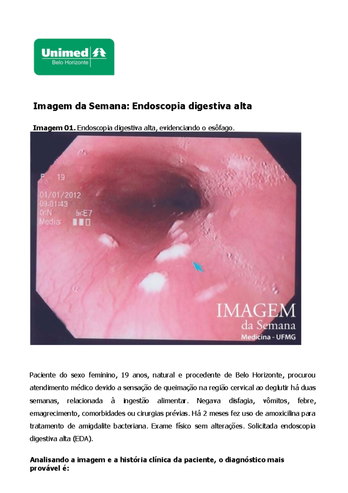 Material Apoio Esofago - Imagem da Semana: Endoscopia digestiva alta ...