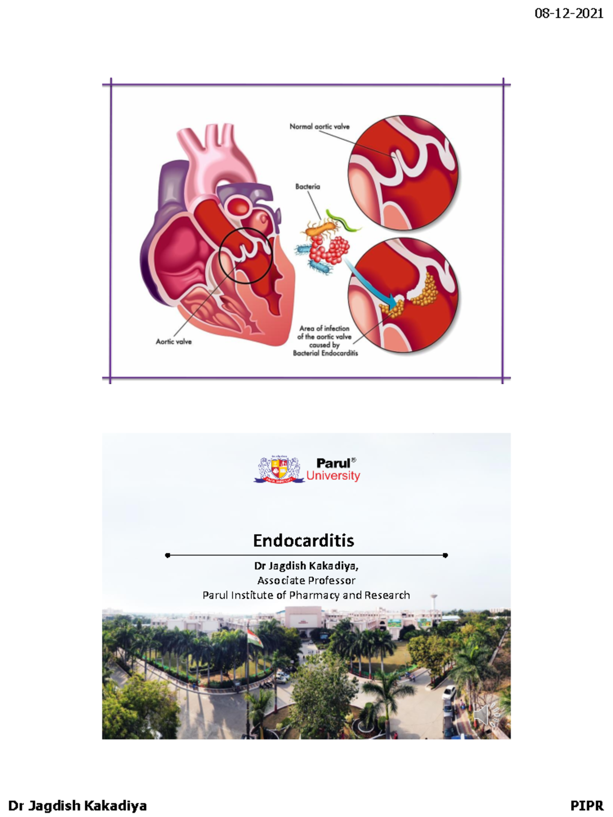 Endocarditis - Most commonly it refers to infection of heart valves by ...