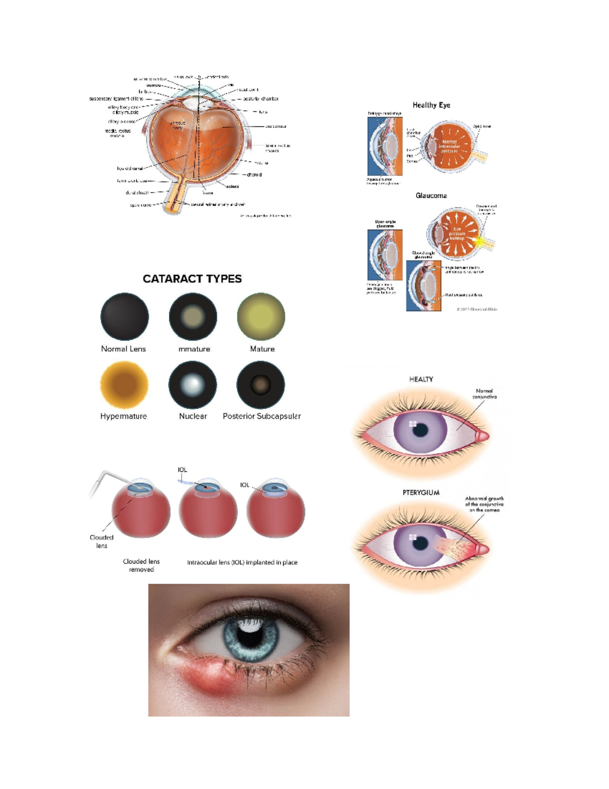 Eye disease illustration - Community Health Nursing - Studocu