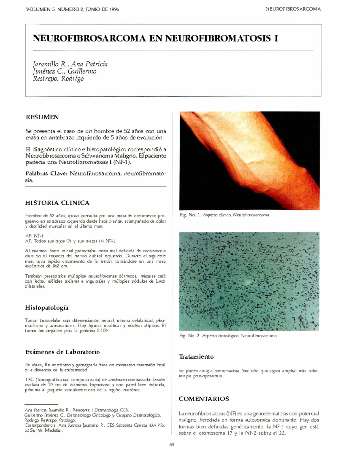 neurofibrosarcoma en neurofibromatosis - VOLUMEN 5, NUMERO 2, JUNIO DE ...