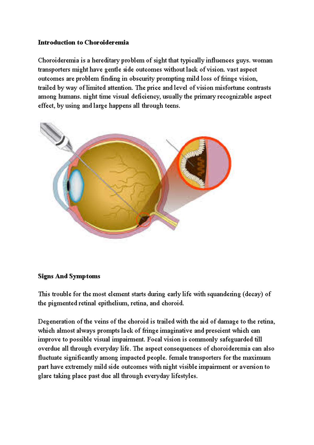 Choroideremia - Introduction to Choroideremia Choroideremia is a ...