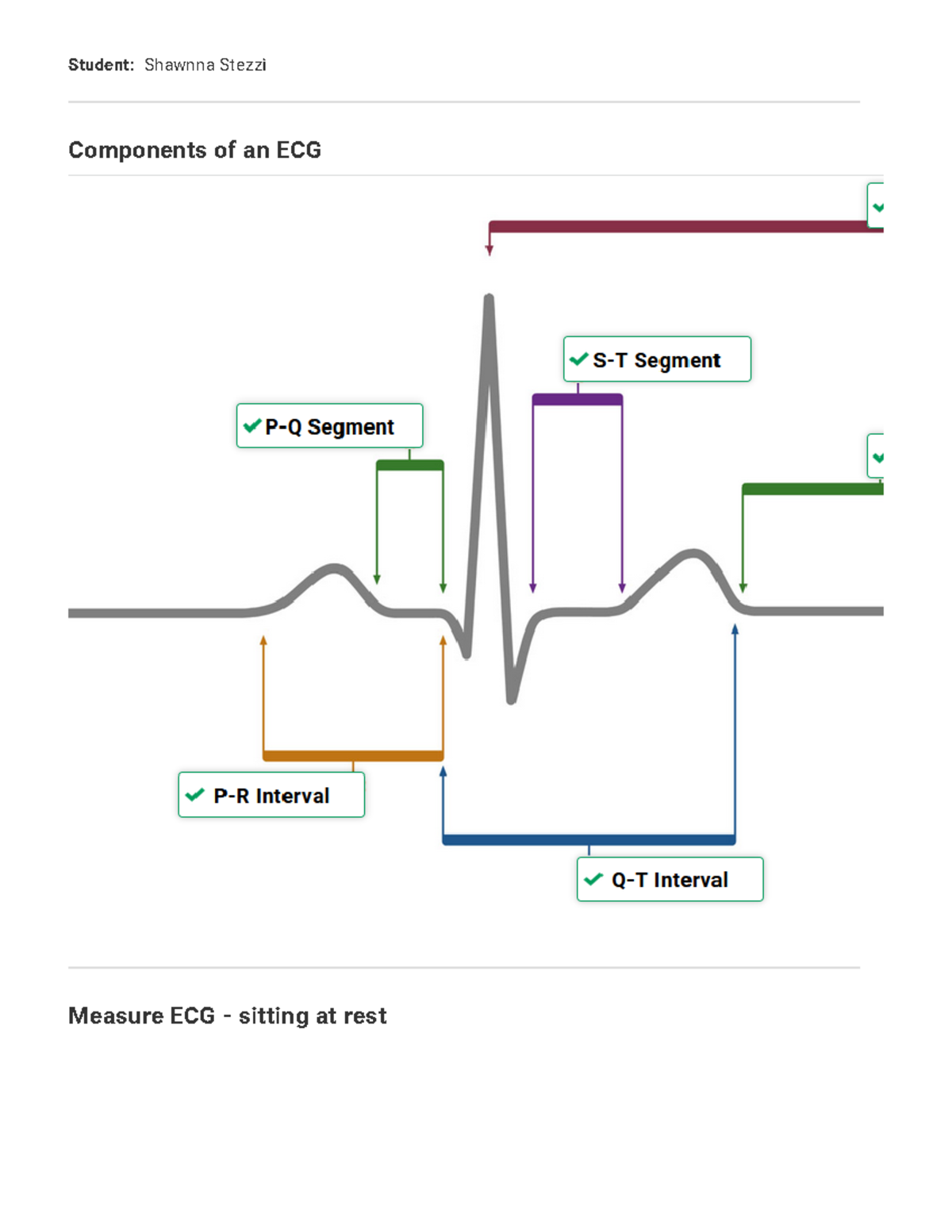 Electrocardiography Lab - Student: Shawnna Stezzi Components of an ECG ...